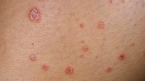 Psoriasis Symptoms Causes And Treatment Avens Blog Avens Blog
